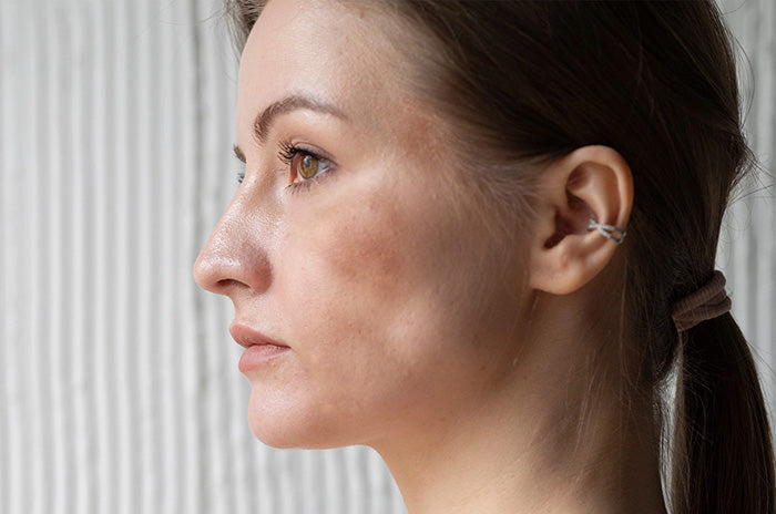 Melasma Skin Condition - AE.R Skinlab