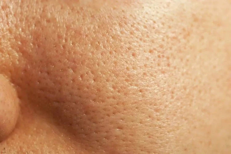 Best Treatment for Large & Open Pores | Face Pore Care - AE.R Skinlab