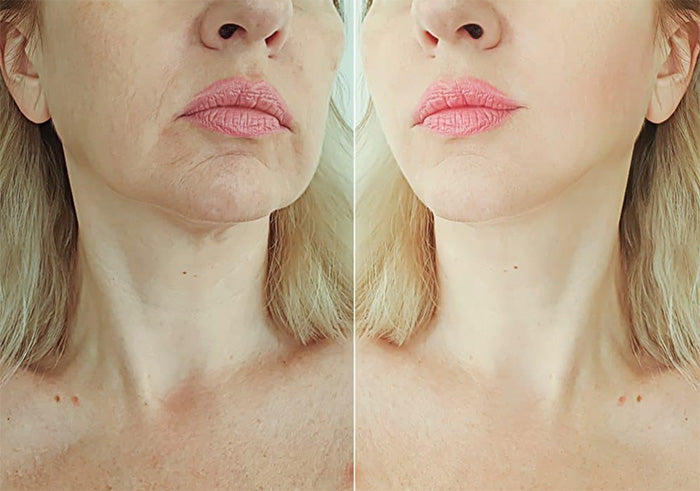 Face Volume Loss Treatment | Restore & Rejuvenate Your Face - AE.R Skinlab
