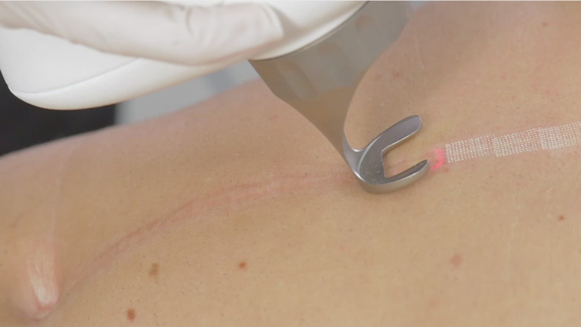 Scar Revision by Fotona - AE.R Skinlab