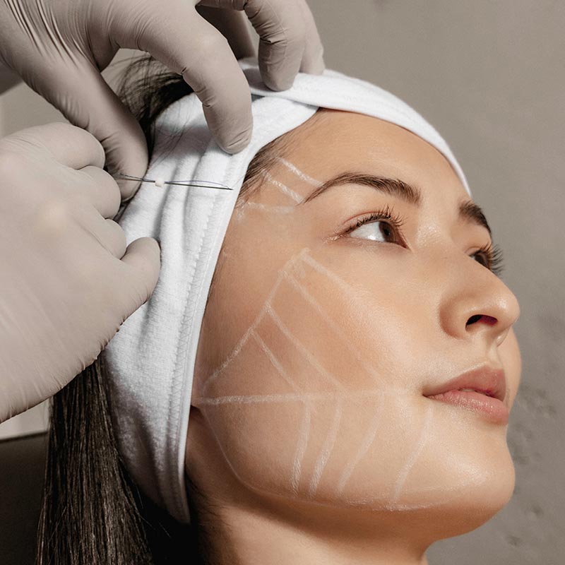 Thread Lift Treatment Vancouver | Face Threading Solutions - AE.R Skinlab